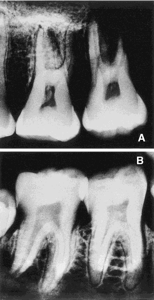 False claims of taurodont teeth in Homo floresiensis